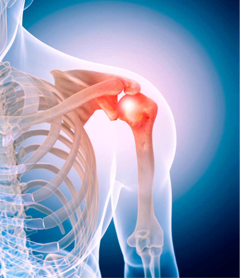 Tout savoir sur la tendinite calcifiante - Labrha