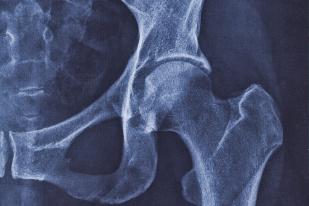 Recommandations Eular pour le traitement de la coxarthrose - Labrha